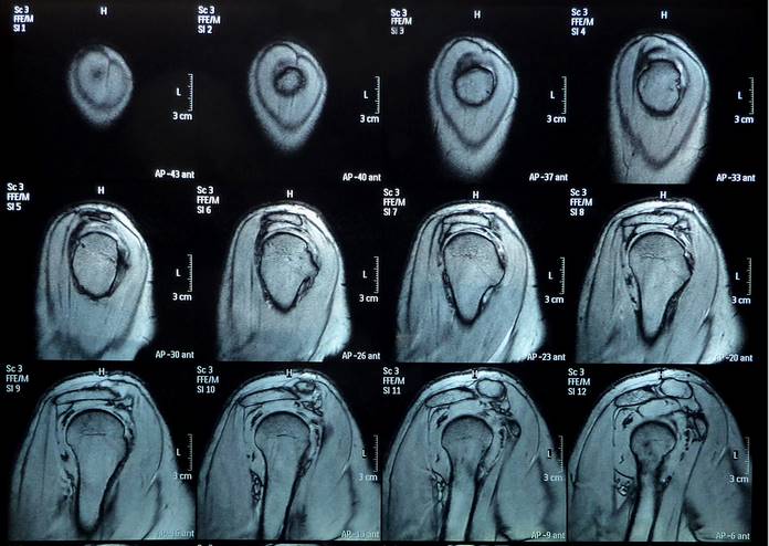 Examinarea Imagistică prin Rezonanță Magnetică IRM a articulație