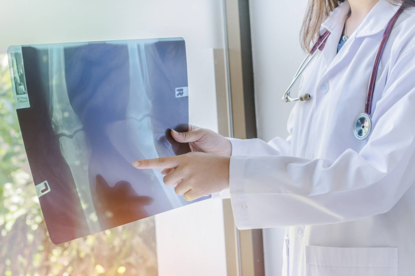 Osteomalacia, boala oaselor moi - cauze, simptome, tratament