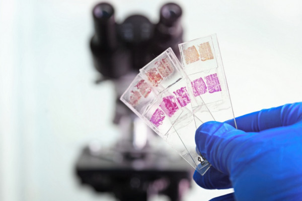 Totul despre biopsie: Ce este, tipuri, riscuri, complicatii