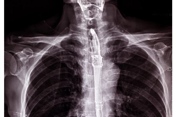 Cancerul esofagian, locul sase in lume in topul mortalitatii prin cancer