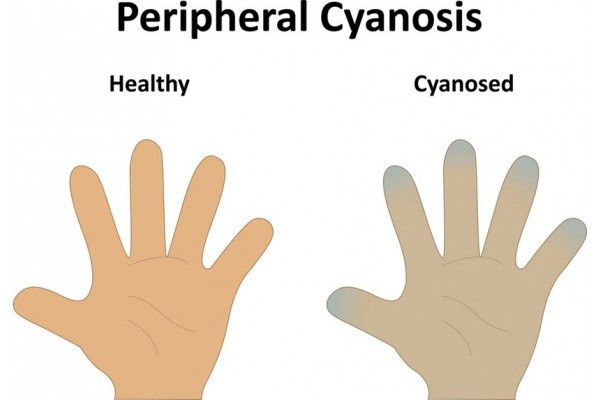 Cum se manifesta cianoza si ce cauze are