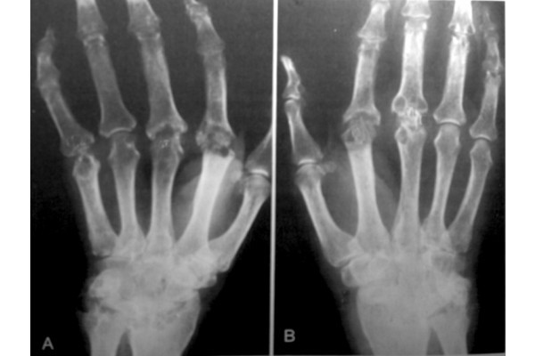 Modificarile radiologice in poliartrita reumatoida