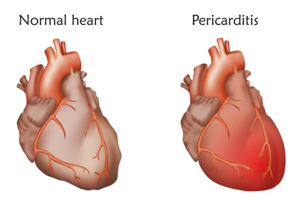Pericardita ("lichid la inima"): cauze, simptome, tratament