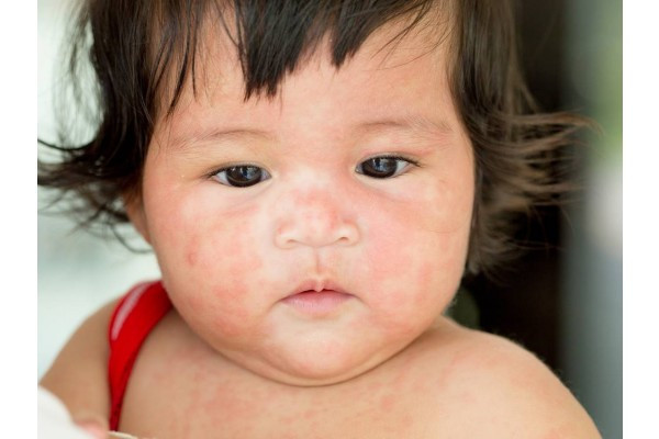 Rubeola: cum se transmite si care sunt simptomele