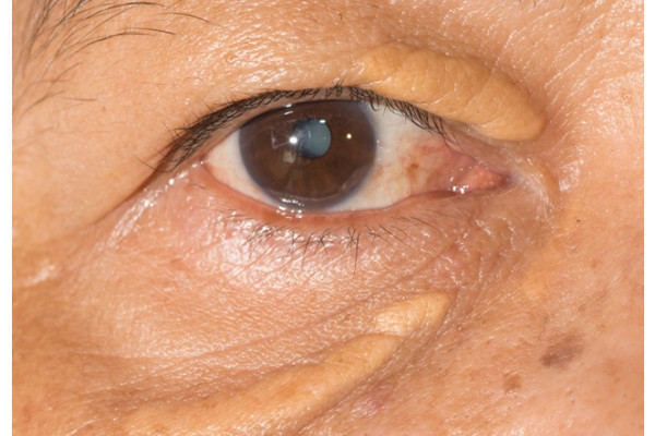 Xantoamele: cauze si diagnostic