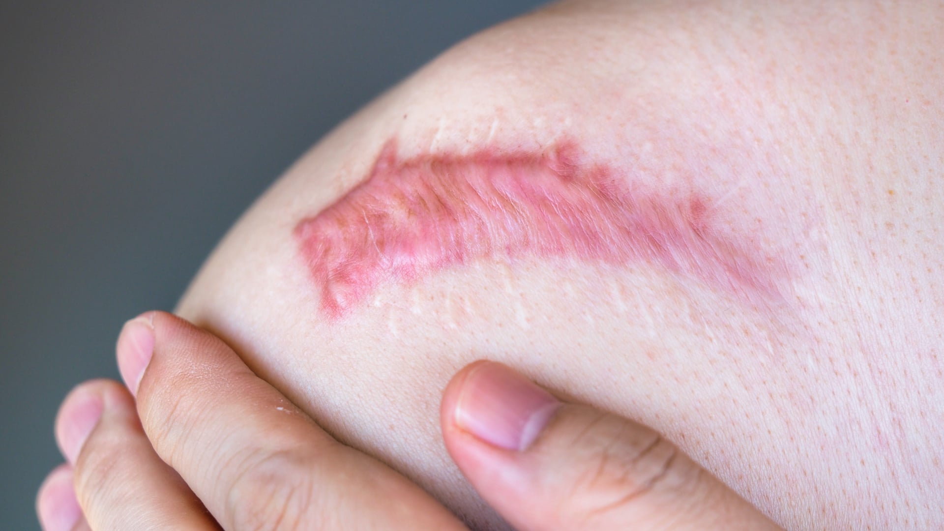 De ce se dezvolta cicatricile cheloide?