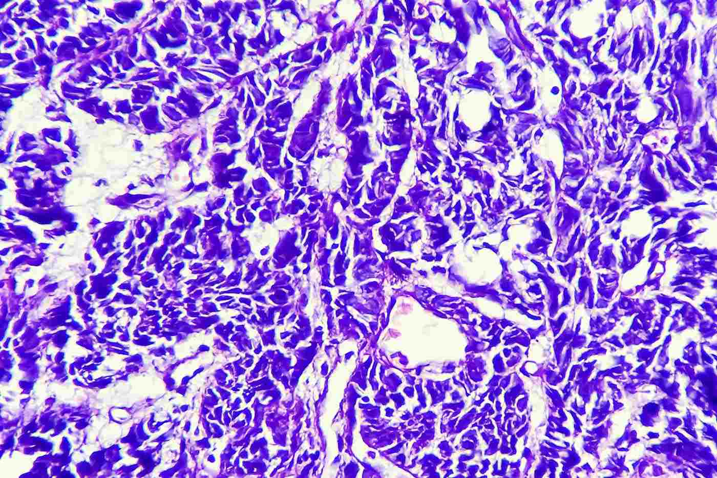 Cum sunt conectate esofagul Barrett si cancerul esofagian?