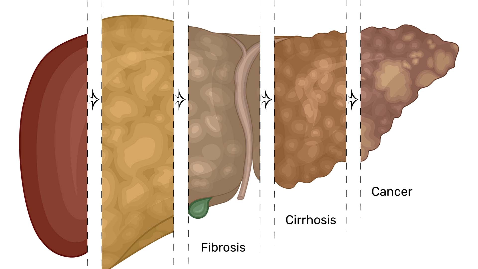 Carcinomul hepatocelular, intre sperante si realitati