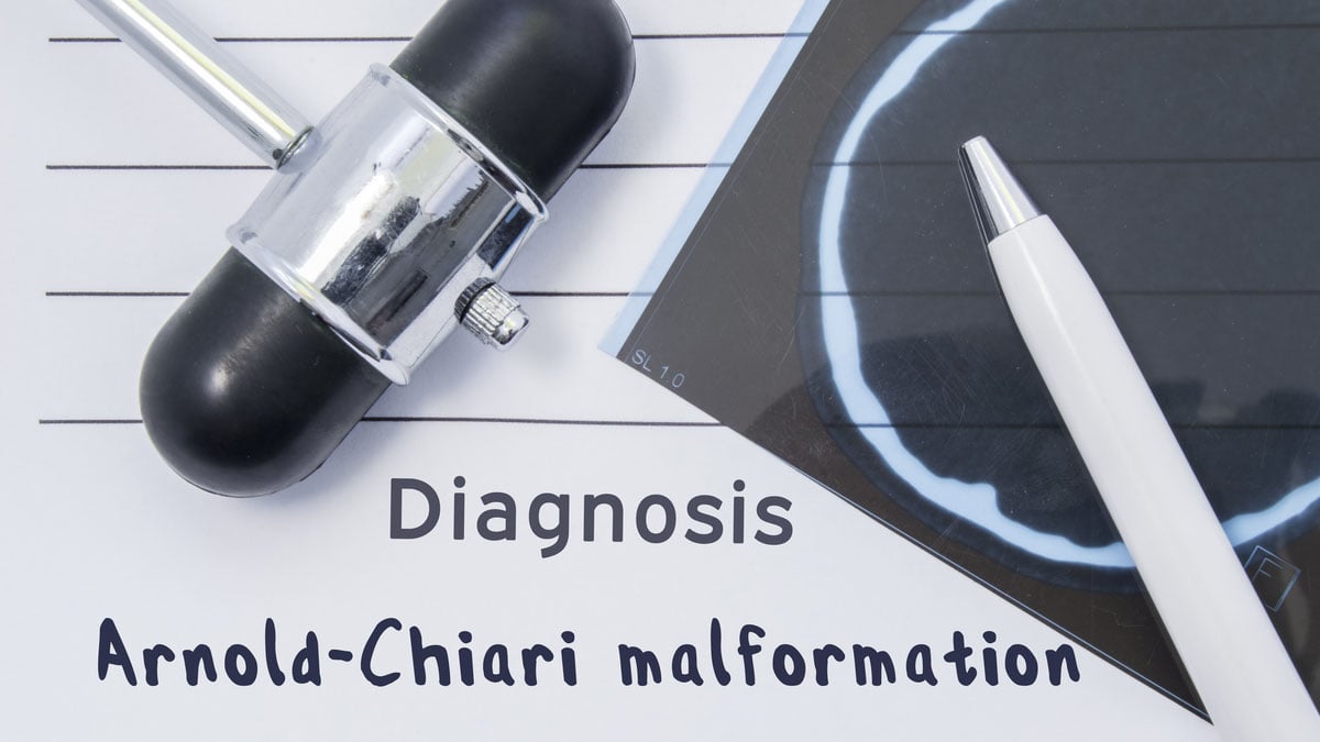 Malformatia Arnold-Chiari: de ce apare, cum se manifesta si cum se trateaza