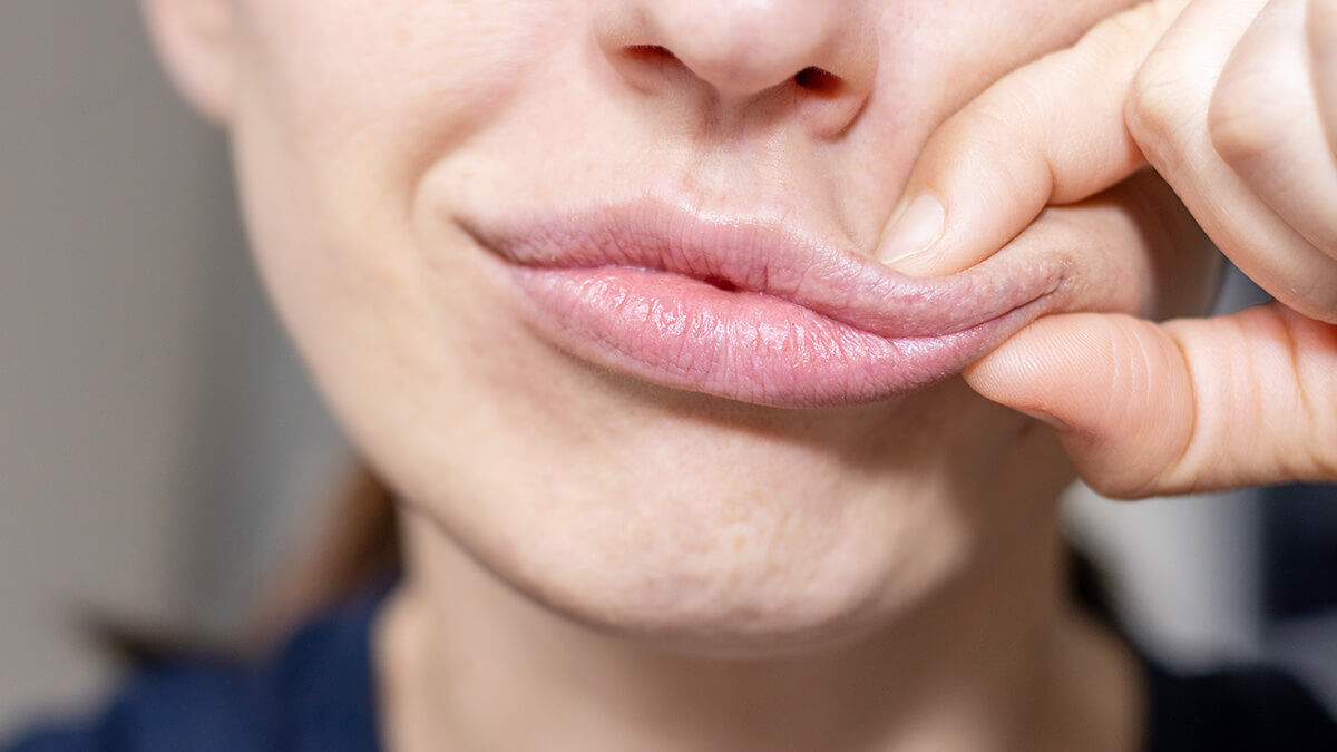 Paralizia Bell: cauze, simptome & tratament