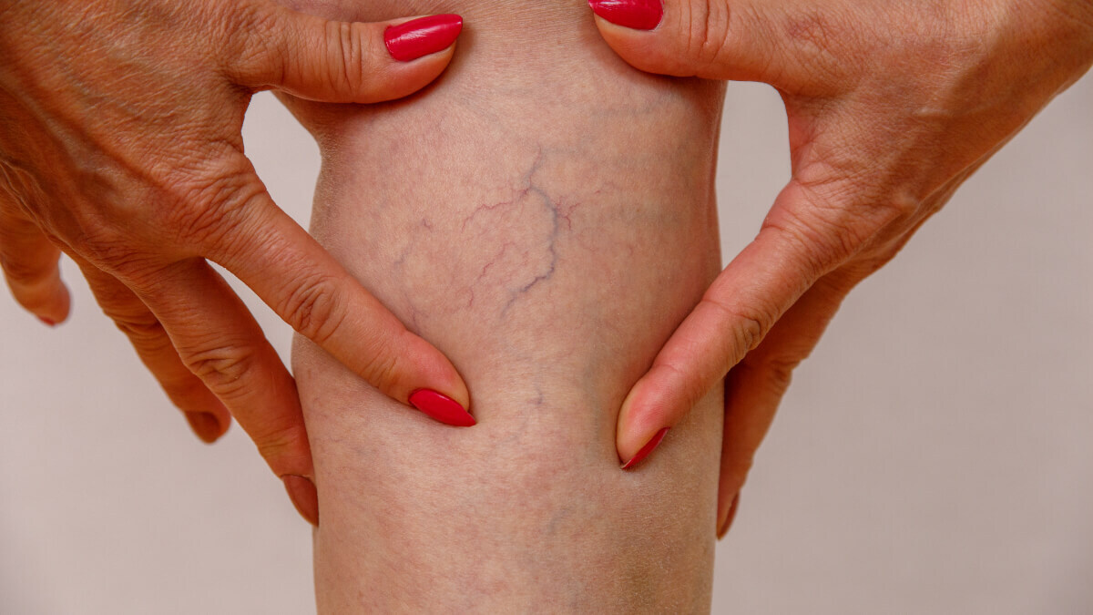 Cat sunt de periculoase varicele daca le lasi netratate?