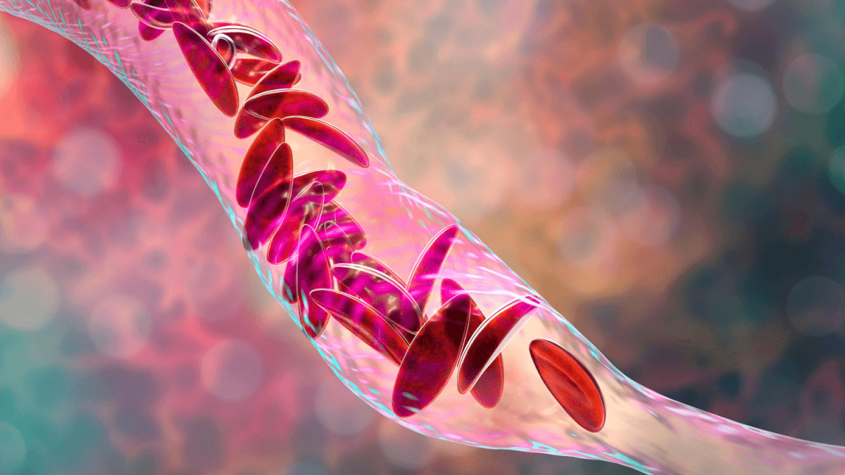 Totul despre siclemie