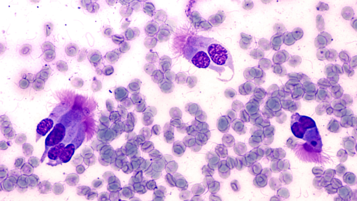 Bronhoscopia (endoscopia bronșică): informații complete