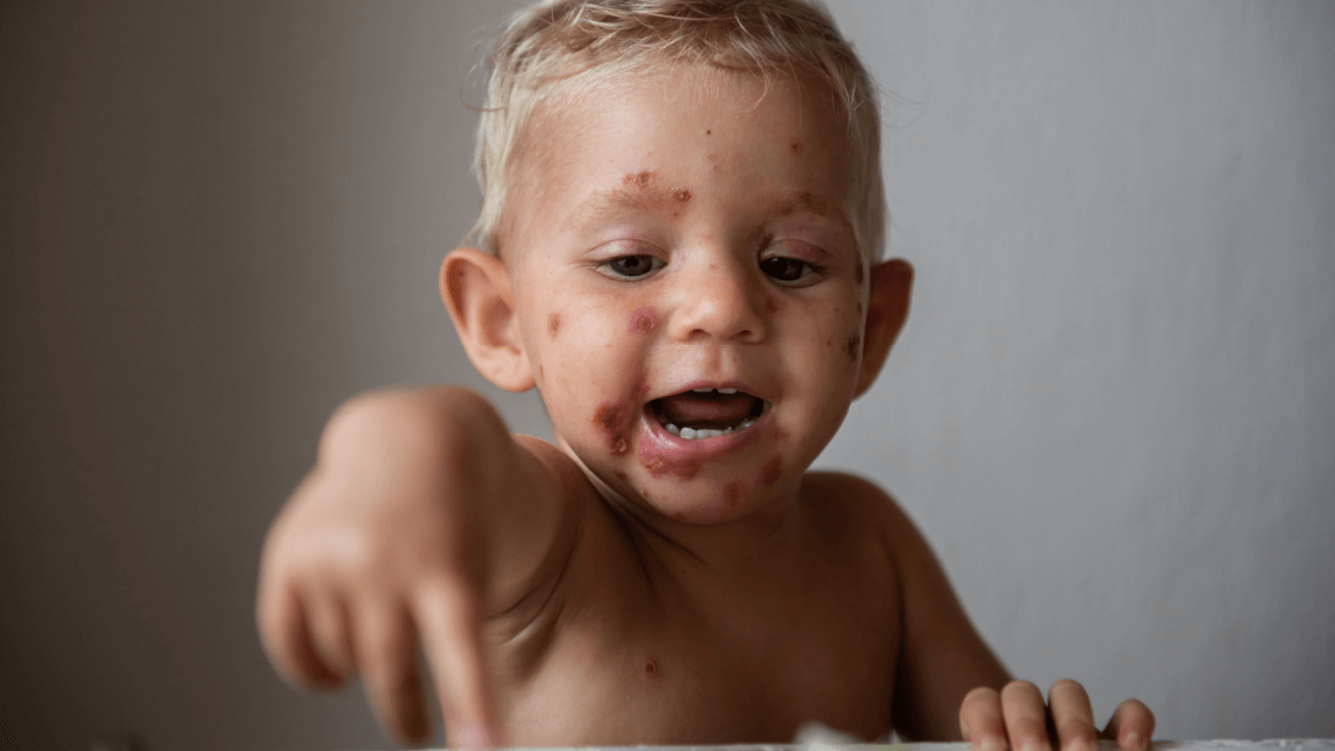 Copilului i-au apărut mici bubițe roșii pe piele? Ar putea fi impetigo