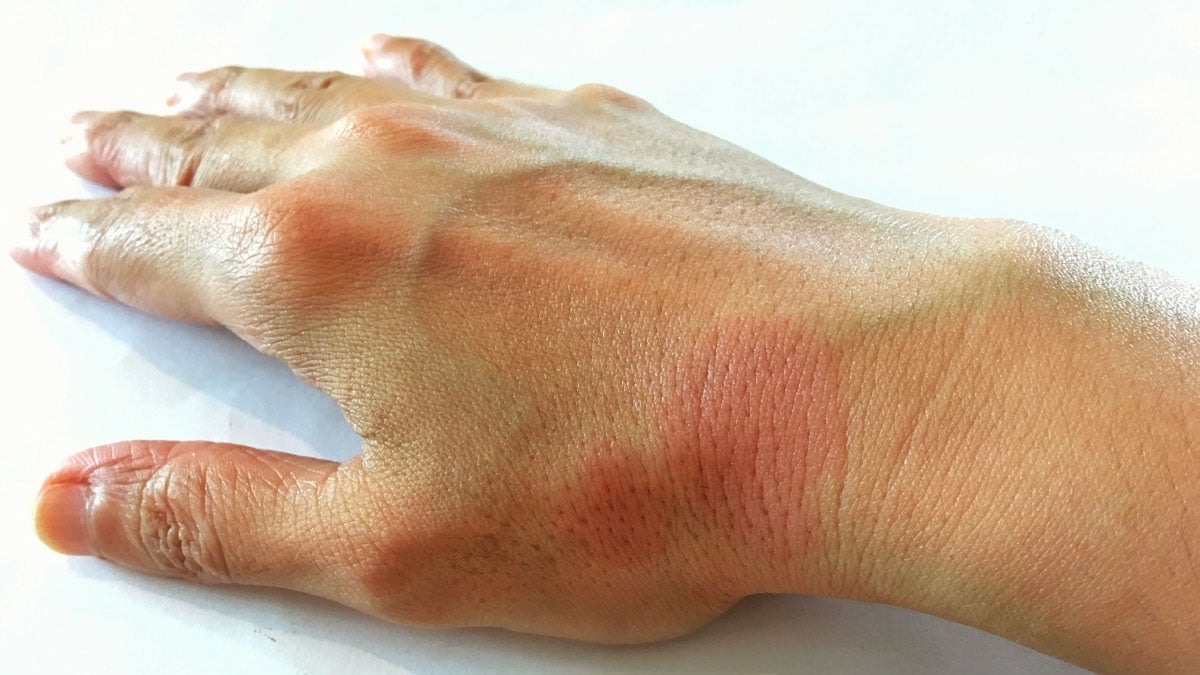 Lupus eritematos cutanat: cauze, simptome si tratament