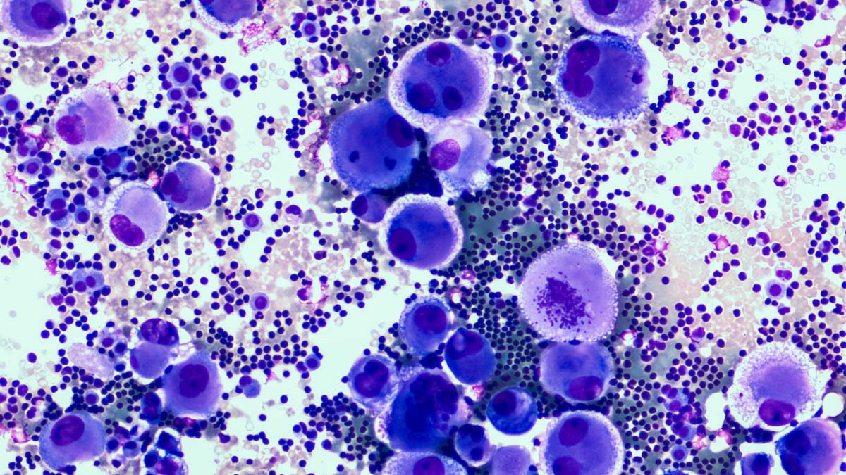 Cancer peritoneal: tipuri, simptome, tratament