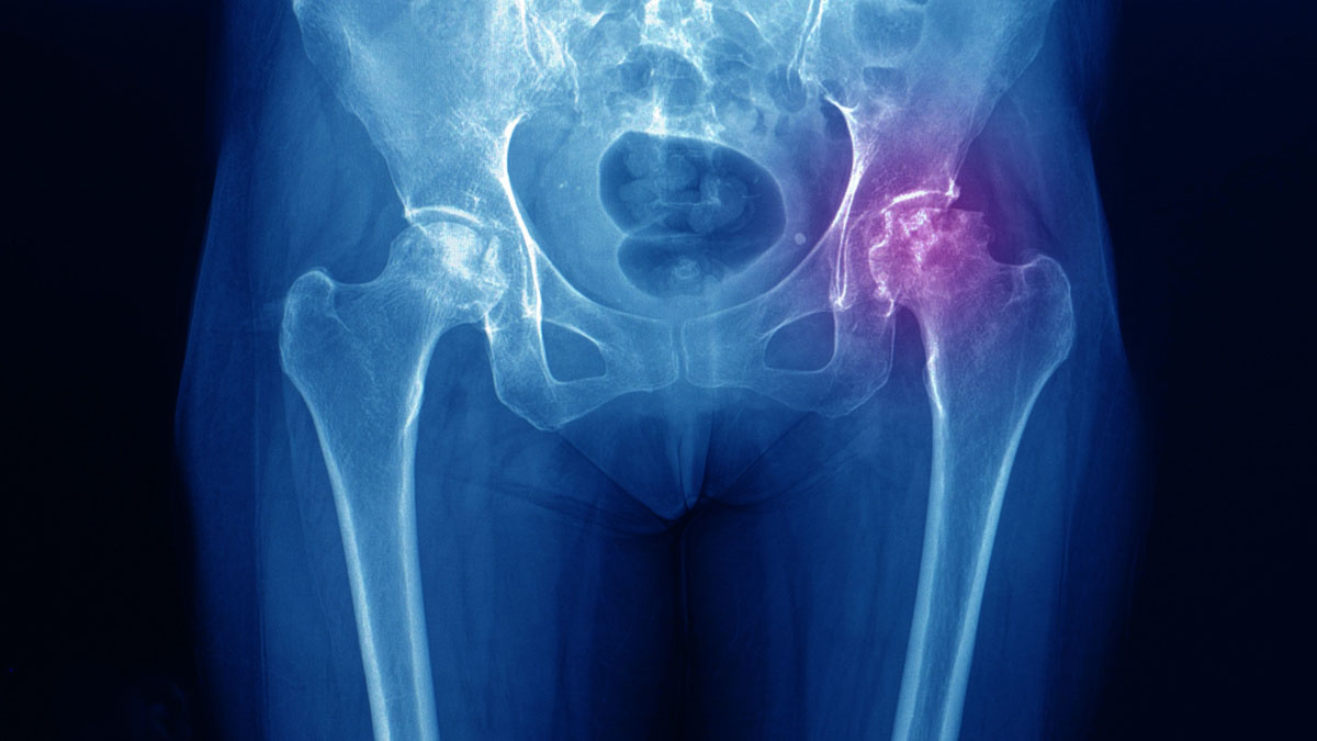 Necroza aseptica de cap femural la pacientii cu lupus