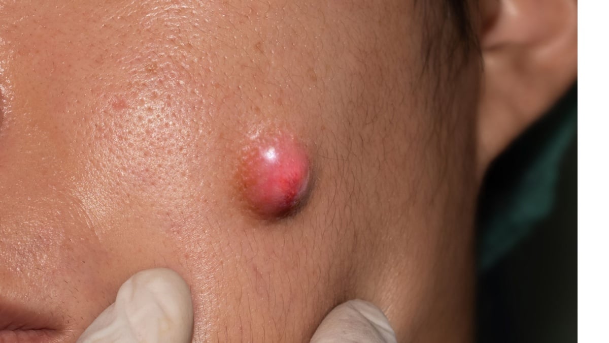 Furunculul: de ce apare si cum il tratam?