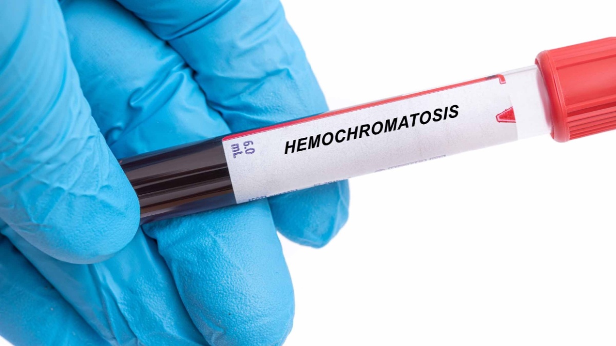 Hemocromatoza sau excesul de fier in organism: simptome si solutii